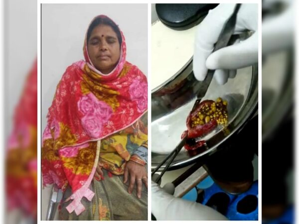 382 batu karang dalam pundi hempedu pesakit - Kosmo Digital