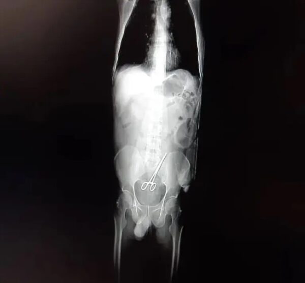 Doktor tertinggal gunting besar dalam usus pesakit - Kosmo Digital