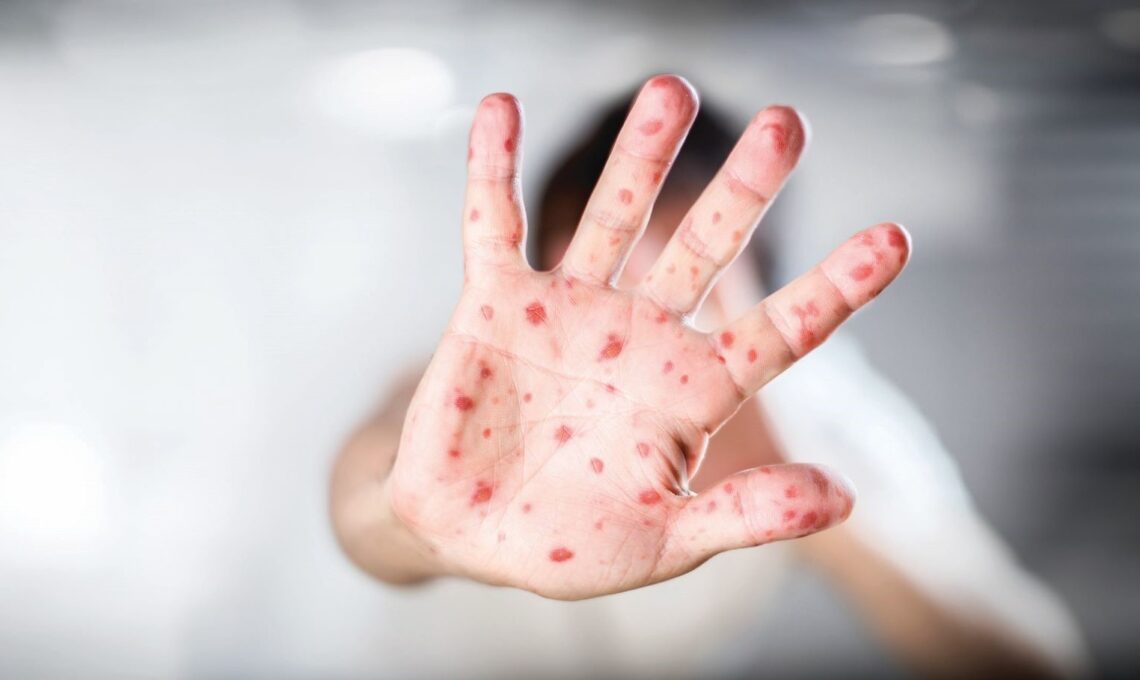 HFMD boleh jangkiti orang dewasa - Kosmo Digital