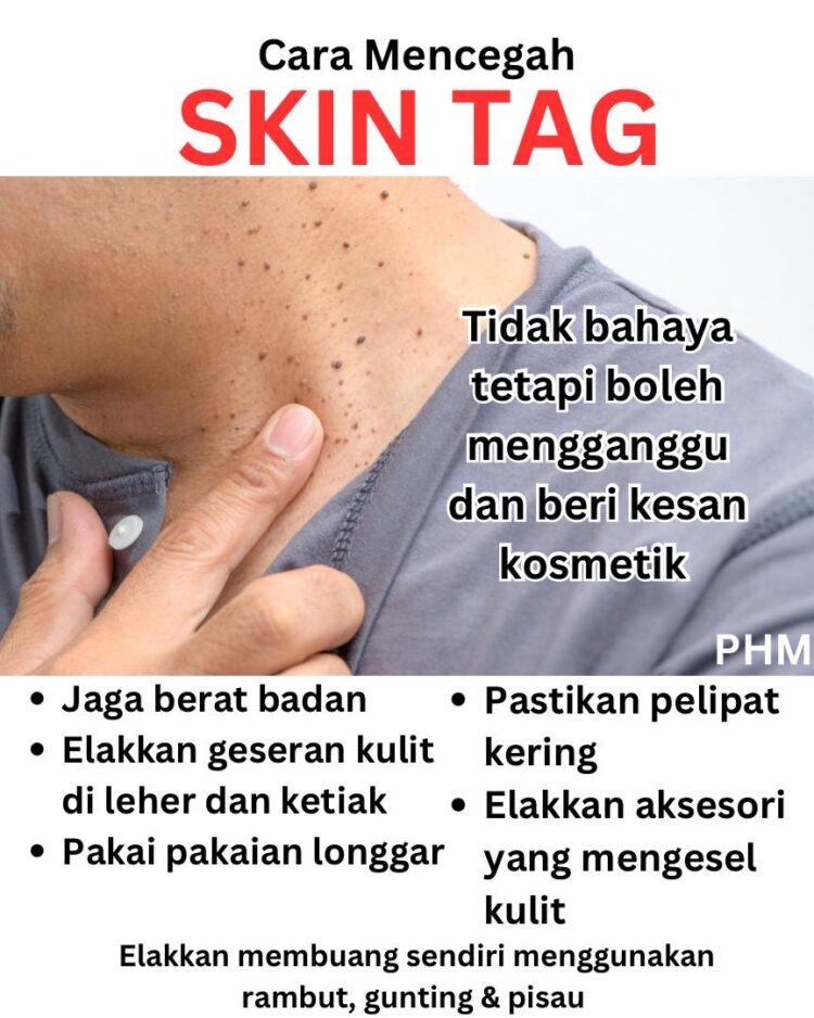 'Skin tag' jejas penampilan, mudarat pada diri - Kosmo Digital