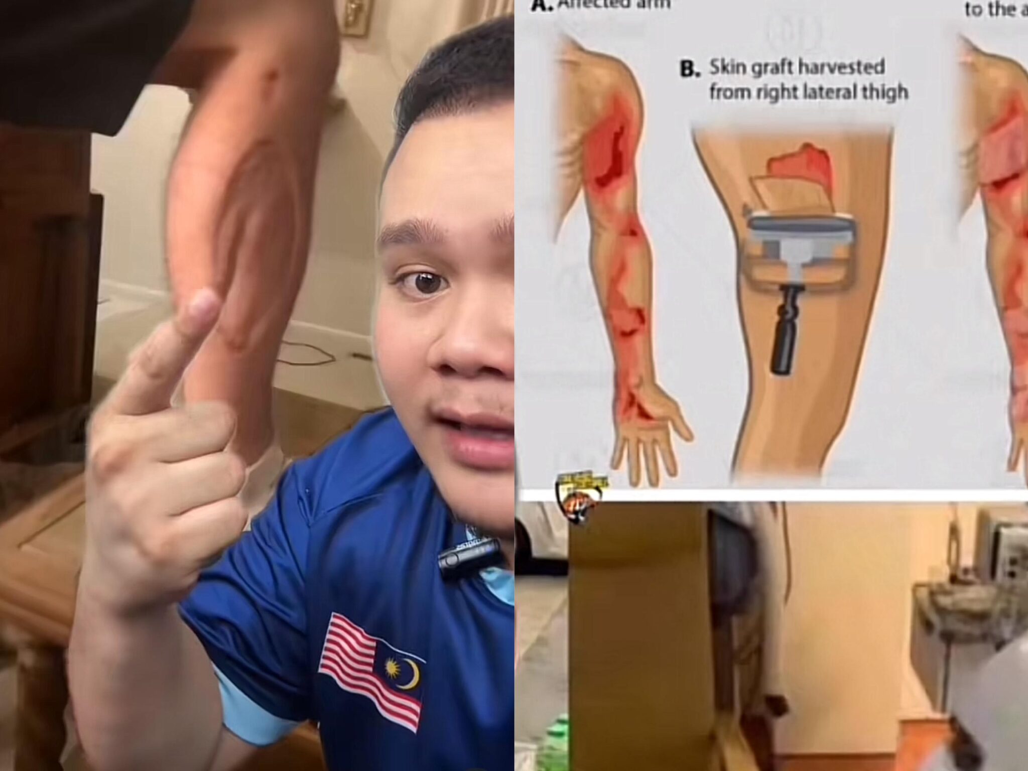 Tampalan kulit baharu Faisal Halim mampu percepat pemulihan luka ...